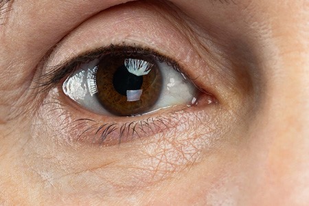 Dark Eye Circle Treatment | Eye Bags Treatment PJ